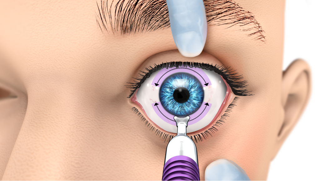 MicroPulse P3® Device - IAPB Valued Supplier Scheme