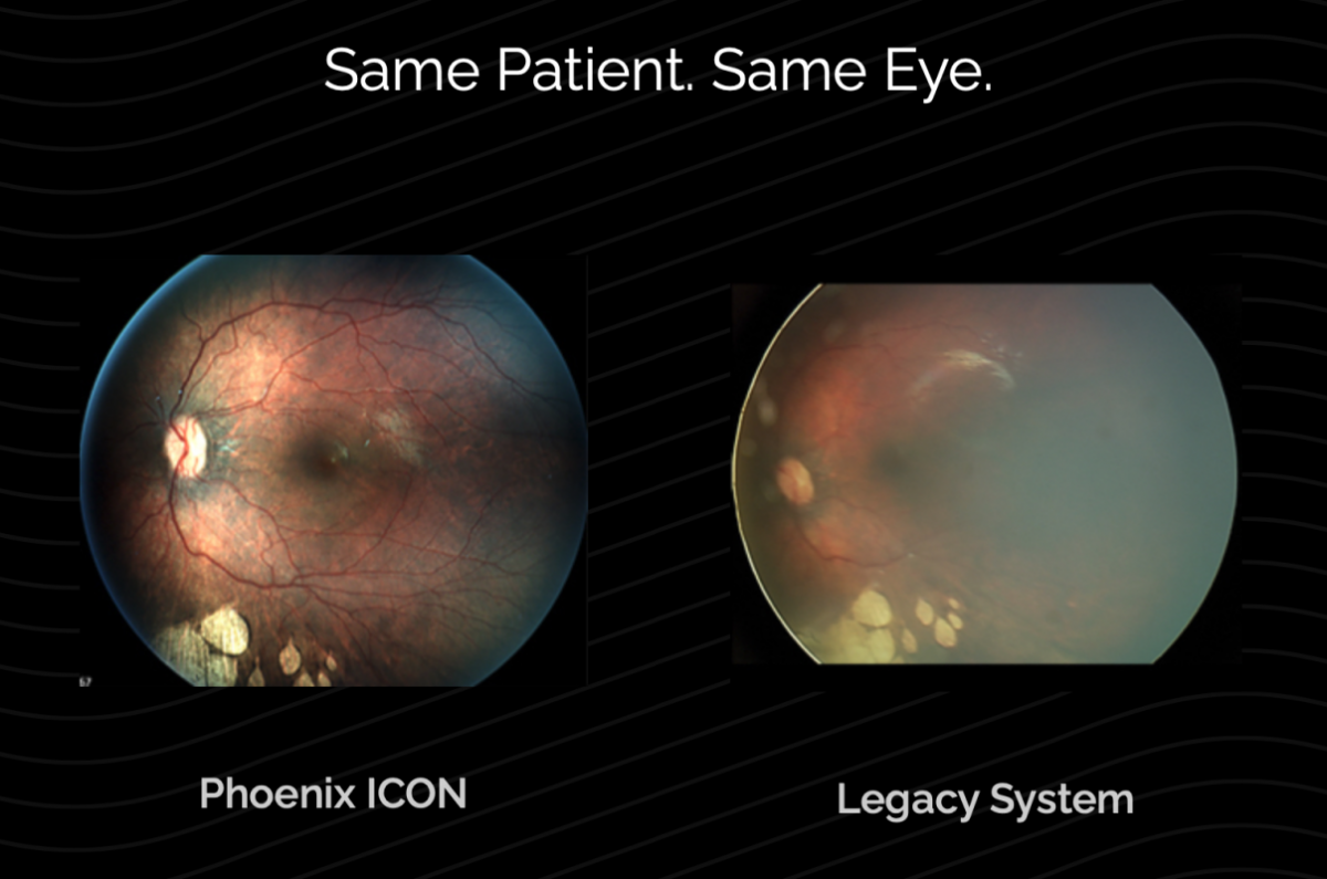 Phoenix ICON™ Cart with Handpiece - IAPB Valued Supplier Scheme